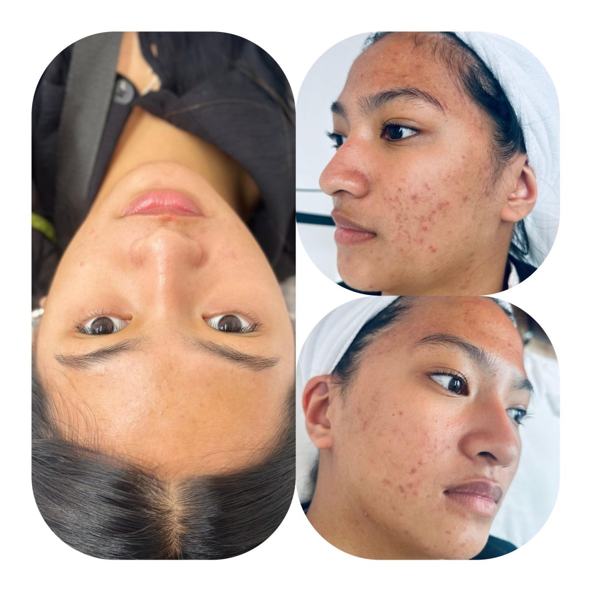 Acne Extraction Treatment - Lashury